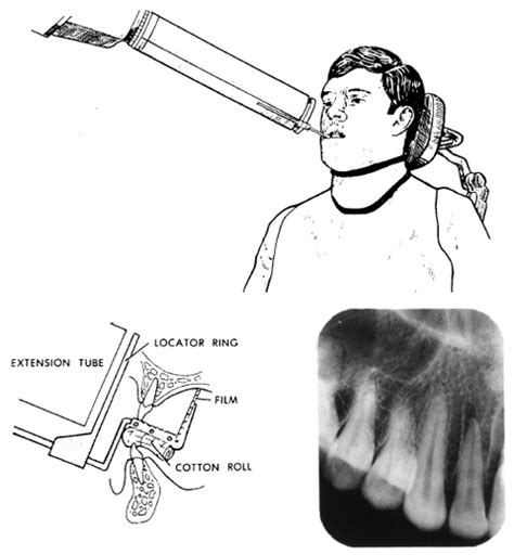 Maxillary Cuspids Lesson 4