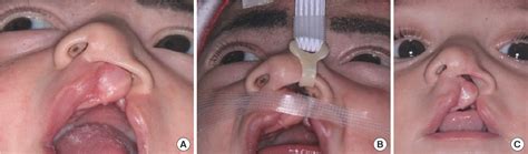 Figure 2 From The Nasoalveolar Molding Technique Versus Dynacleft Nasal
