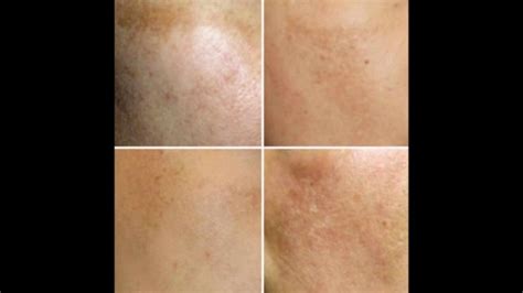 자신있게 노마스크 눈가 광대주변 기미치료는 첨단 피코토닝부터 레이저토닝 병행한 피부과전문의 시술로 해결해요 네이버 블로그