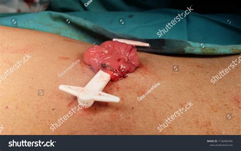 Stoma Defunctioning Sigmoid Colostomy Patient Obstructed Foto Stock