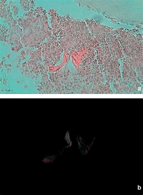 A Irregular Crystalloid Amyloid Deposits Embedded In Bone Marrow Download Scientific Diagram