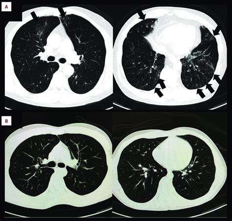 A Chest Computed Tomography Images Showing Diffuse Small Nodular Download Scientific Diagram