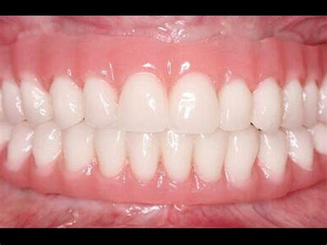 Fixed Bridges Vs Fixed Dentures The Complete Guide
