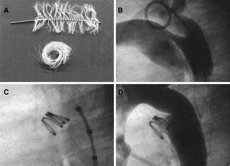 Patent Ductus Arteriosus Circulation