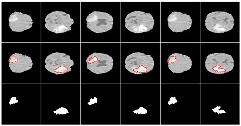 A Deep Learning Framework For Segmenting Brain Tumors Using Mri And Synthetically Generated Ct
