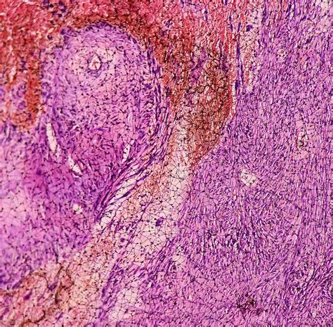 Gist Diagnostyka I Leczenie Eksperci O Zdrowiu