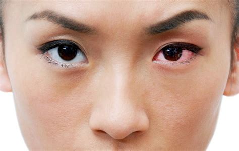 사라지지 않는 눈 속 실핏줄 방치하면 실명까지