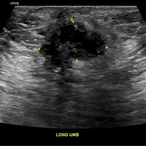 Abdominal Ultrasound Demonstrates A 25 X 14 X 14 Cm Complex Solid