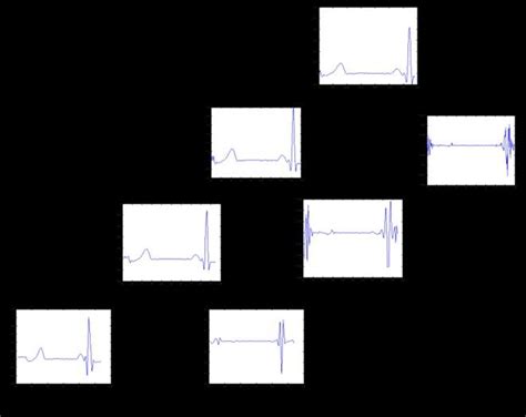 Wavelet Decomposition Of The Ecg Signal Download Scientific Diagram