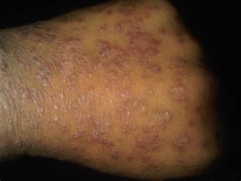 BN Skin Deep Series The Rash That Changed My LifeLiving With Psoriasis BellaNaija