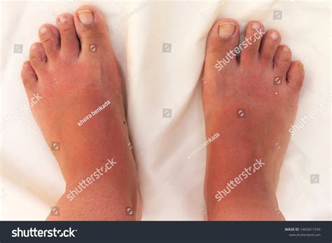 Heat Rash Tanning Bed Photos And Images Shutterstock