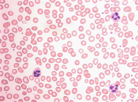 Megaloblastic Anemia Peripheral Smear Megaloblastic Anemia Peripheral Smear