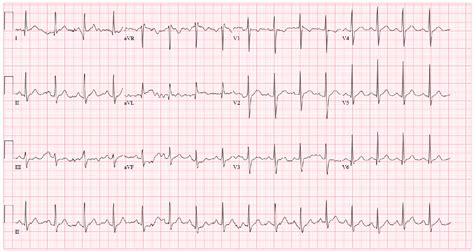 Isolated Jup Plakoglobin Gene Mutation With Left Ventricular Fibrosis