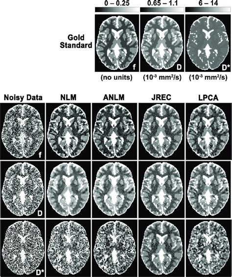 parameter maps of the perfusion fraction f first row the diffusion