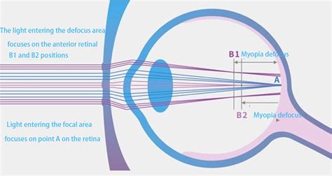 What Is A Defocus Lens