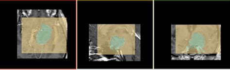 Modules GrowCutSegmentation Documentation 3 6 Slicer Wiki