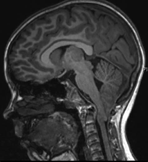 Imaging In Chiari I Malformation Neurosurgery Clinics
