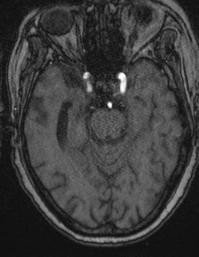 Choroid Plexus Xanthogranuloma Unilateral Radiopaedia 85632 101393 Axial Tof Nc Commons