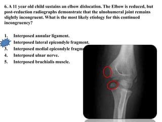 Medial Epicondyle Fracture Pediatricppt