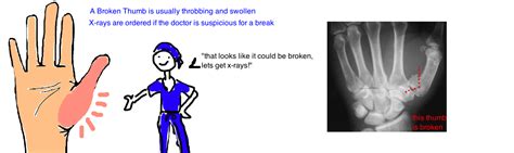 Broken Thumb First Metacarpal Fracture — Bone Talks