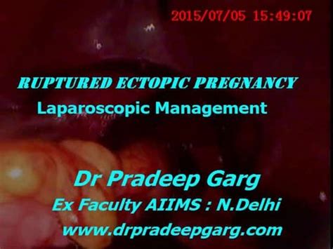 Laparoscopic Sacrocolpopexy For Vaginal Vault Prolapse With Prolene Mesh Dr Pradeep Garg Ppt