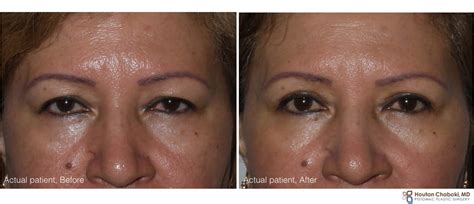 Brow Vs Bleph Lift The Brow Andor The Upper Eyelid With Plastic