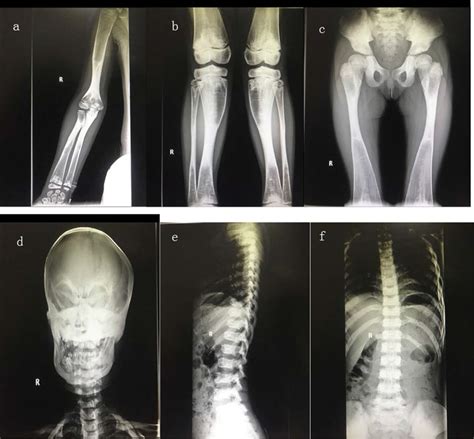 A C The Structure Of Limb Bones Is Deformed Extreme Metaphyseal