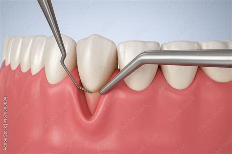 3d Illustration Of Gum Recession Examination With Dental Tools Exposed