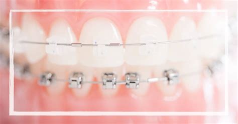 What Are Power Chain Braces Ultimate Guide Year