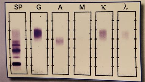 Immunofixation Interpretation Chart Flashcards Quizlet