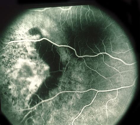 Choroidal Melanoma Retina Image Bank