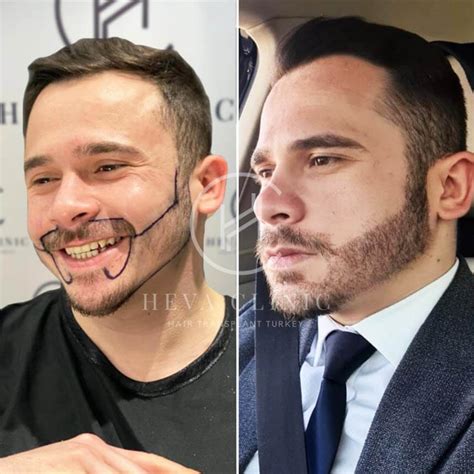 Facial Hair Transplant In Turkey Beard Transplant Cost 2026 Heva