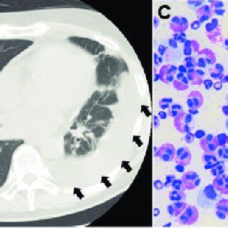 A X Ray And B Computed Tomography CT Images Of The Patient On Download Scientific Diagram