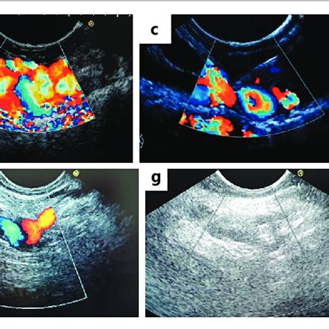 A Large Esophageal Varices Were Found Under Egd B Large Paraesophageal