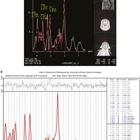 Representative Single Voxel Spectroscopy Spectrum Single Voxel