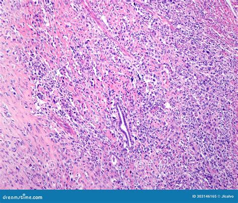 Human Uterus Sarcoma Stock Image Image Of System Microscopy 303146165