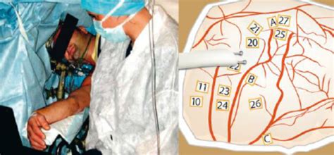 Awake Surgery Consists In Removing Tumoral Non Functional Tissue Download Scientific Diagram