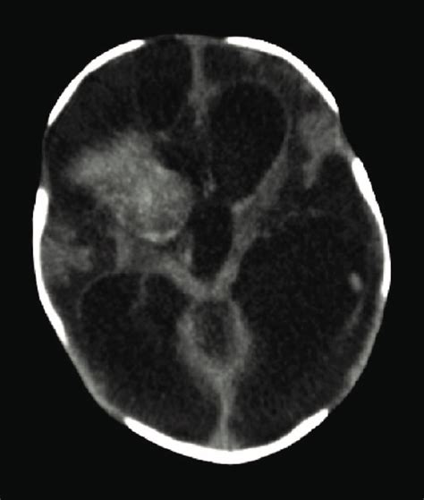 The Ct Scan Of The Brain Of The Preterm Neonate With Posthemorrhagic Download Scientific