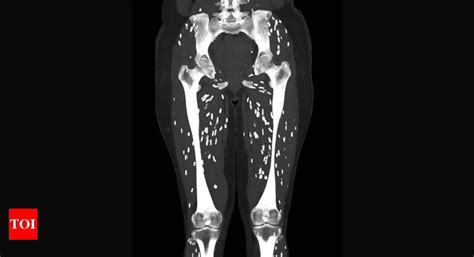 Craziest Ct Scan Reveals Tapeworm Cysts In Patients Legs Know Why This Happened Times Of