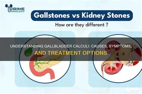 Understanding Gallbladder Calculi Causes Symptoms And Treatment