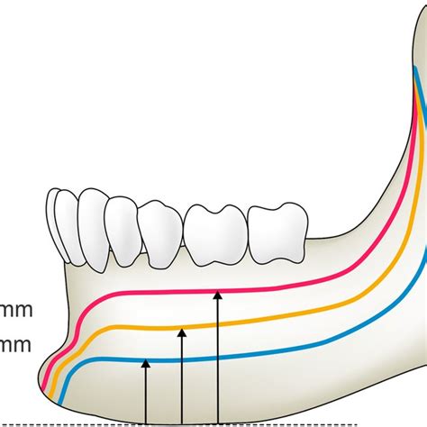 Luhr Classification Of The Edentulous Mandible According To The Degree