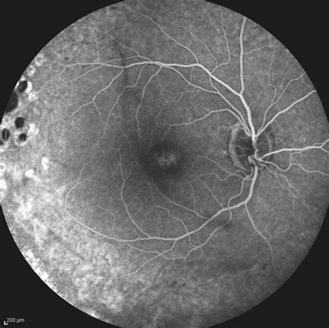 X Linked Retinoschisis Genetics And Management