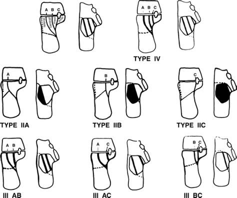 Calcaneus Fracture Classification