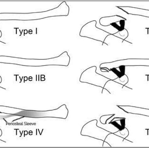 Universal Classication System Of Clavicle Fractures Robinson Et Al 1