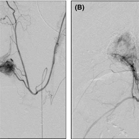 Ct Fluoroscopy Axial Image During Rfa Adrenal Radiofrequency Ablation