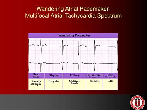 Ppt Supravetricular Tachyarrhythmias Part 1 Powerpoint Presentation Free Download Id3136357