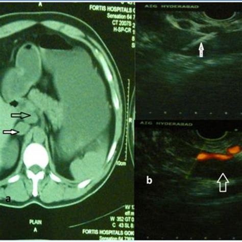 A ERCP Showing Smooth Tapering Of Lower CBD With Upstream Dilation Of Download Scientific