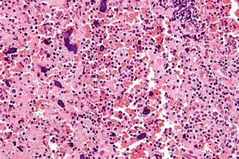 Types Of Lupus That Need To Be Known