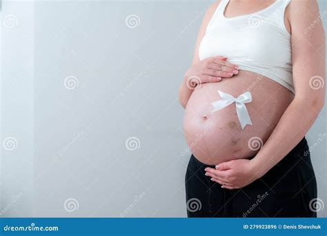 A Pregnant Girl Holds A Big Belly Decorated With A Bow And Bruises