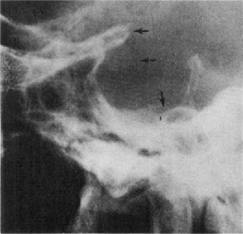Figure 1 From Intrasellar Arachnoid Diverticulum Semantic Scholar